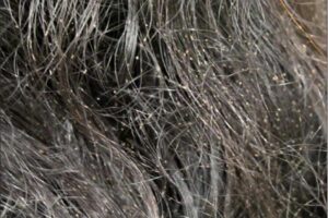 Como acabar com caruncho no cabelo?